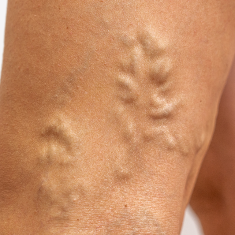 What is Vein Mapping? - The Vein Center of Maryland