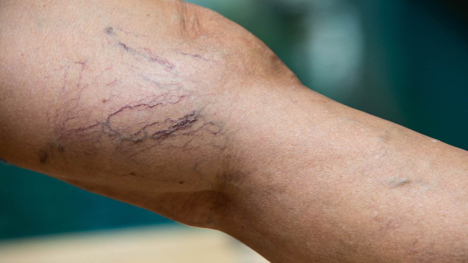 Why Do My Veins Pop Out? - The Vein Center of Maryland